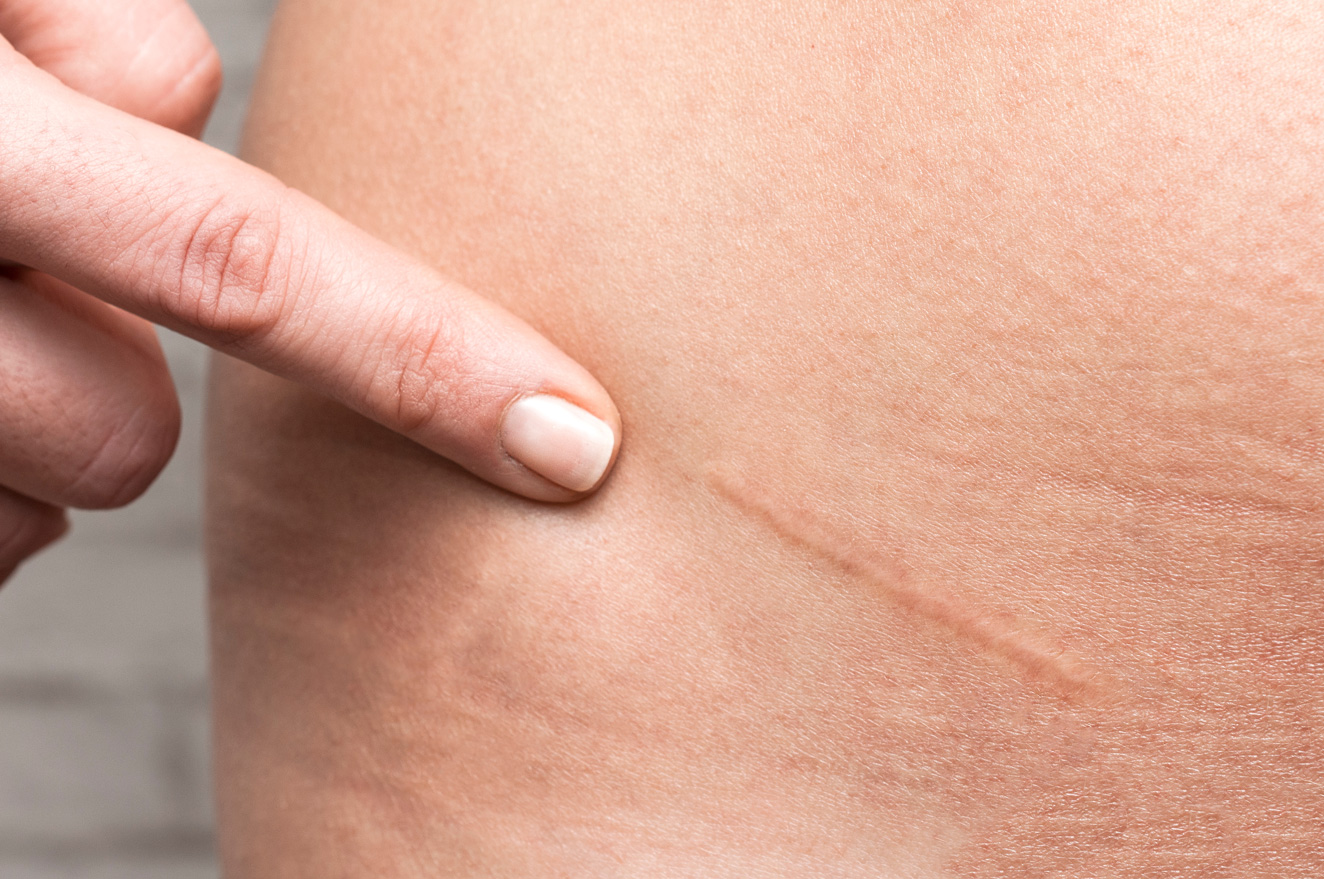 Microneedling improves appearance of surgical scars – especially if ...