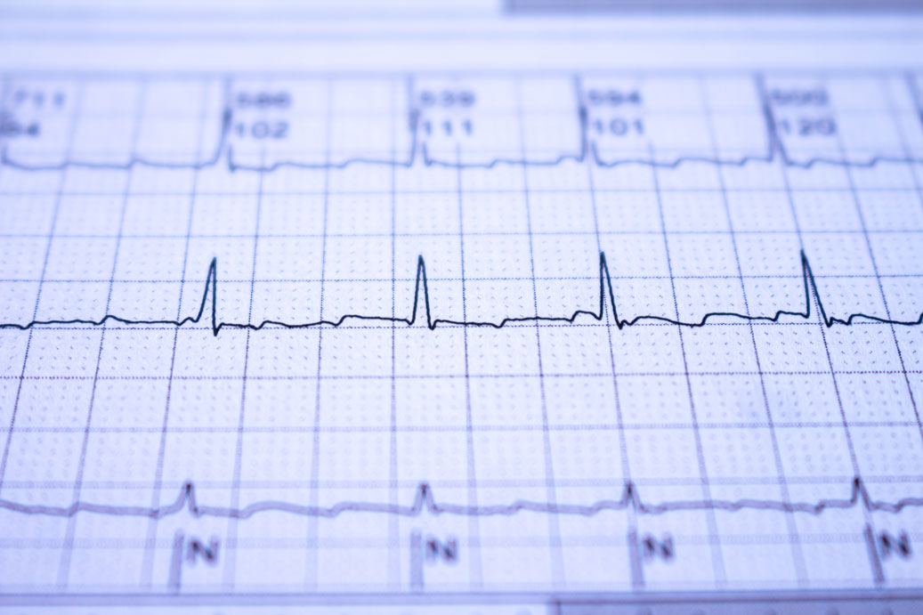 FDA approval for PulseSelect Pulsed Field Ablation (PFA) system for the ...